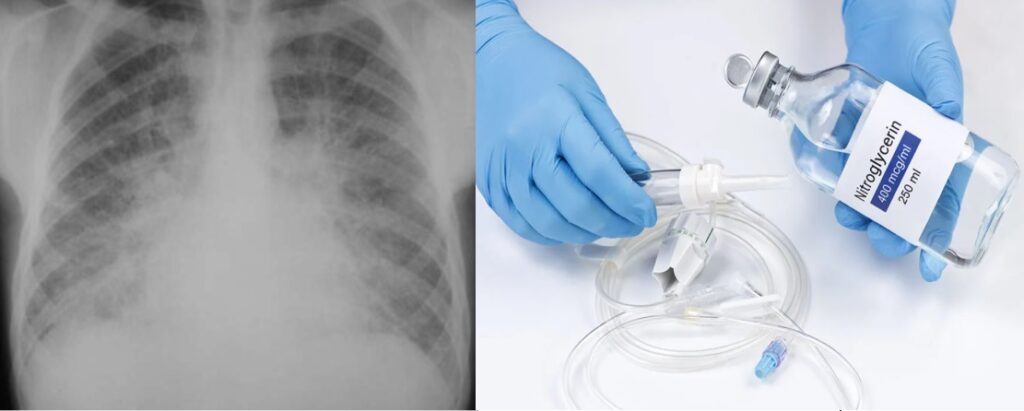 IV Nitro to the Rescue - Pinto Pearls